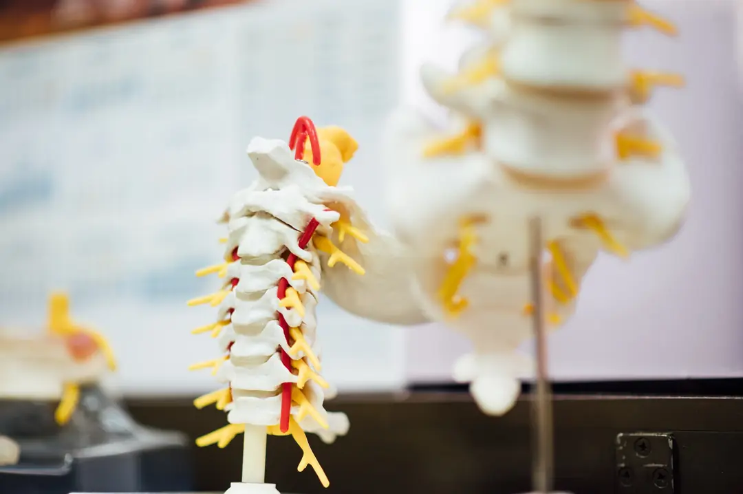 Bulding Nedir? Diffüz Bulging, Posterior Bulging ve Minimal Bulging Ne ...