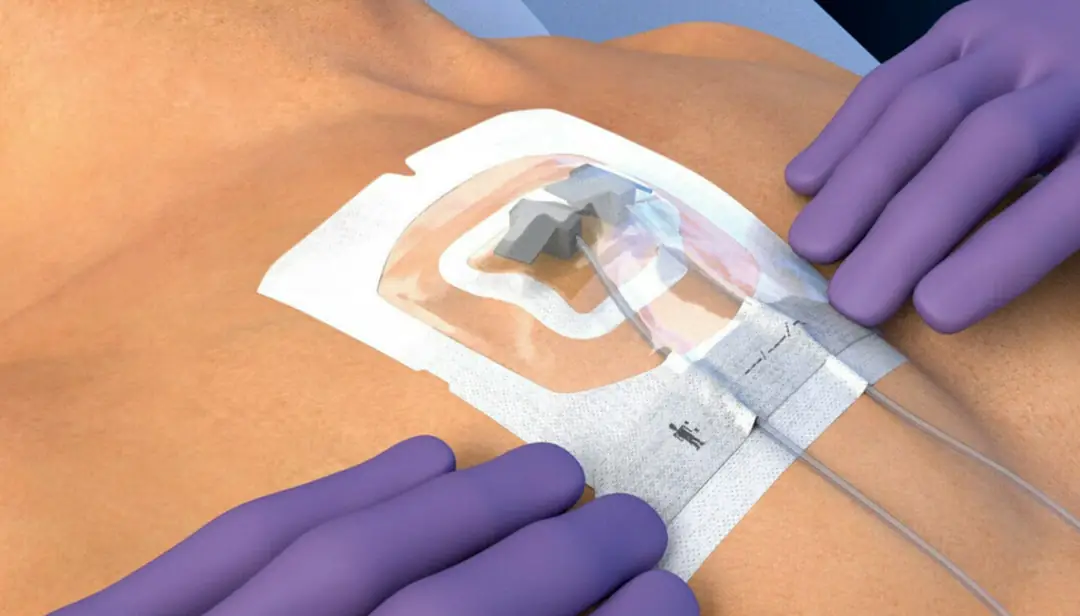 Tegaderm CHG Chloarhexidine Glukonat I.V. Port Örtüsü 12 cm x 12 cm ...