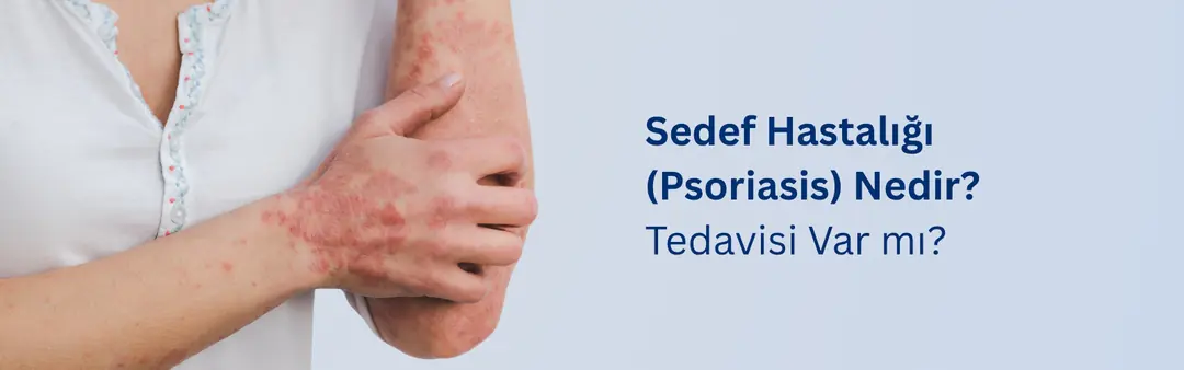 Sedef Hastalığı (Psoriasis) Nedir? Tedavisi var mı?