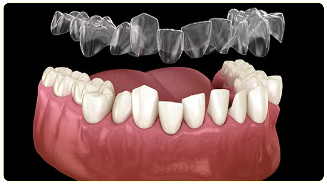 New Aligner Resins: A Technology that Combines Aesthetics and Functionality